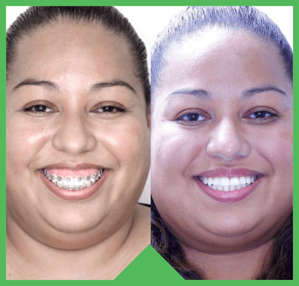 Gummy Smiles Treatment in Encino, CA - Orthodontics LA